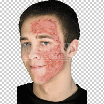 Free: Scarred Burn Scar Contracture Face PNG, Clipart, Burn, Burn Scar ...