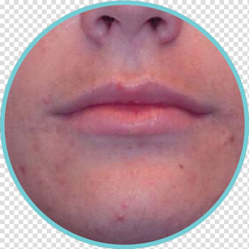 Free: Acne PNG Images | Vector and PSD Files | Free Download on Pngtree ...