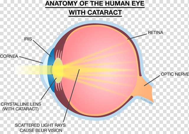 Free: Light Eye Lens Strength Training Anatomy Cataract, light ...
