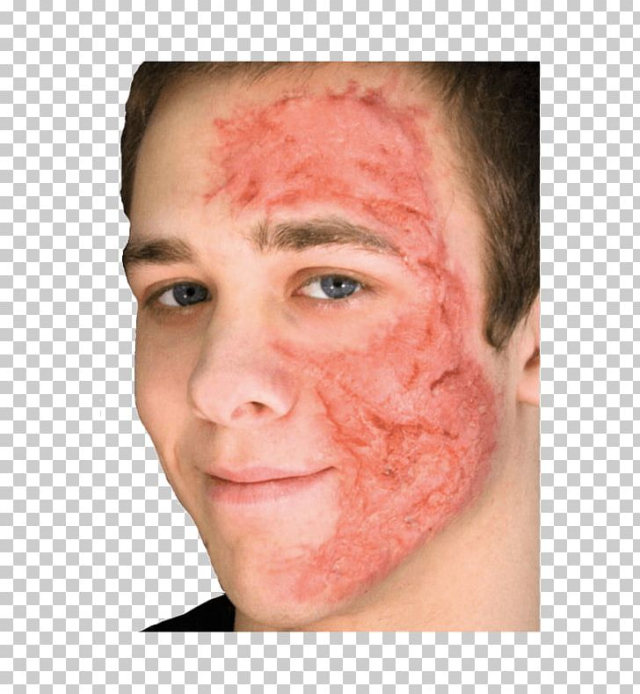 Free: Scarred Burn Scar Contracture Face PNG, Clipart, Bruise, Burn ...