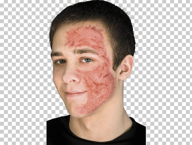 Free: Scarred Burn Scar Contracture Face PNG, Clipart, Burn, Burn Scar ...