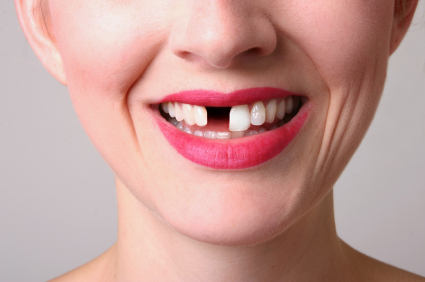 Free: Tooth Gap PNG Transparent Tooth Gap.PNG Images. | PlusPNG - nohat.cc